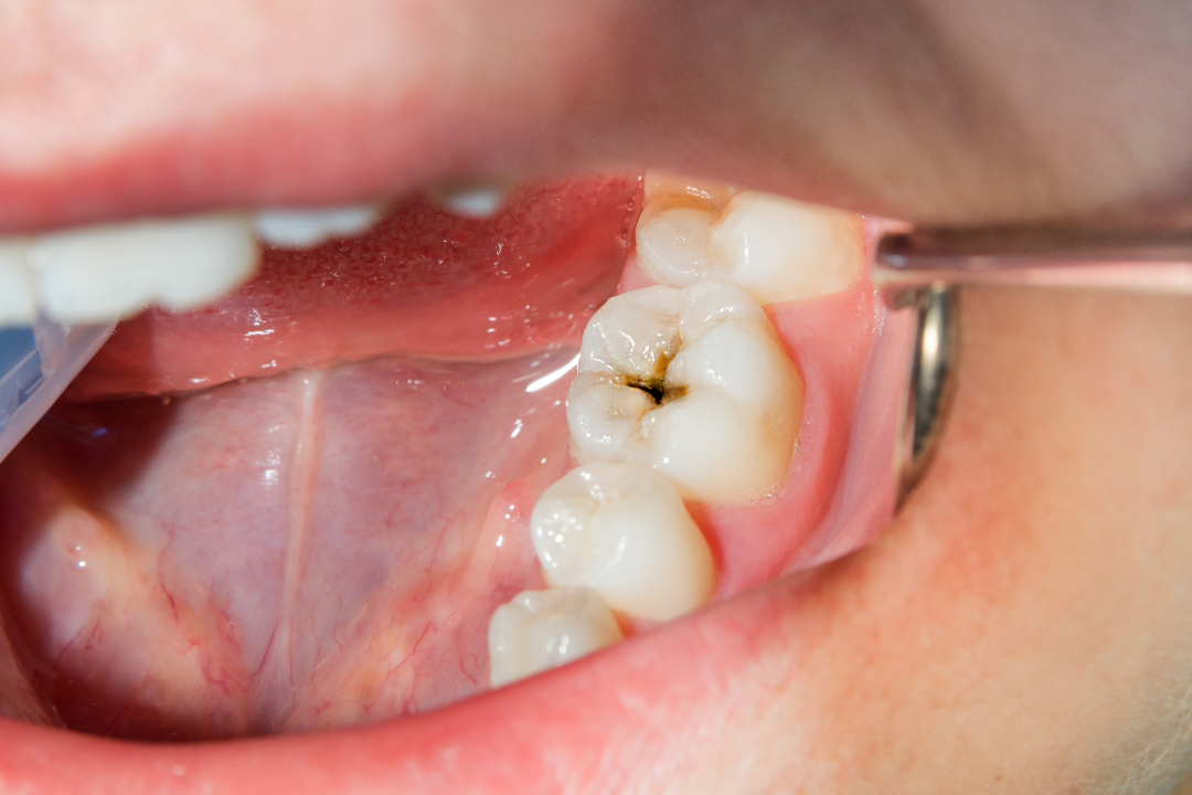 What Does a Cavity Look Like | Identify & Prevent | Blog